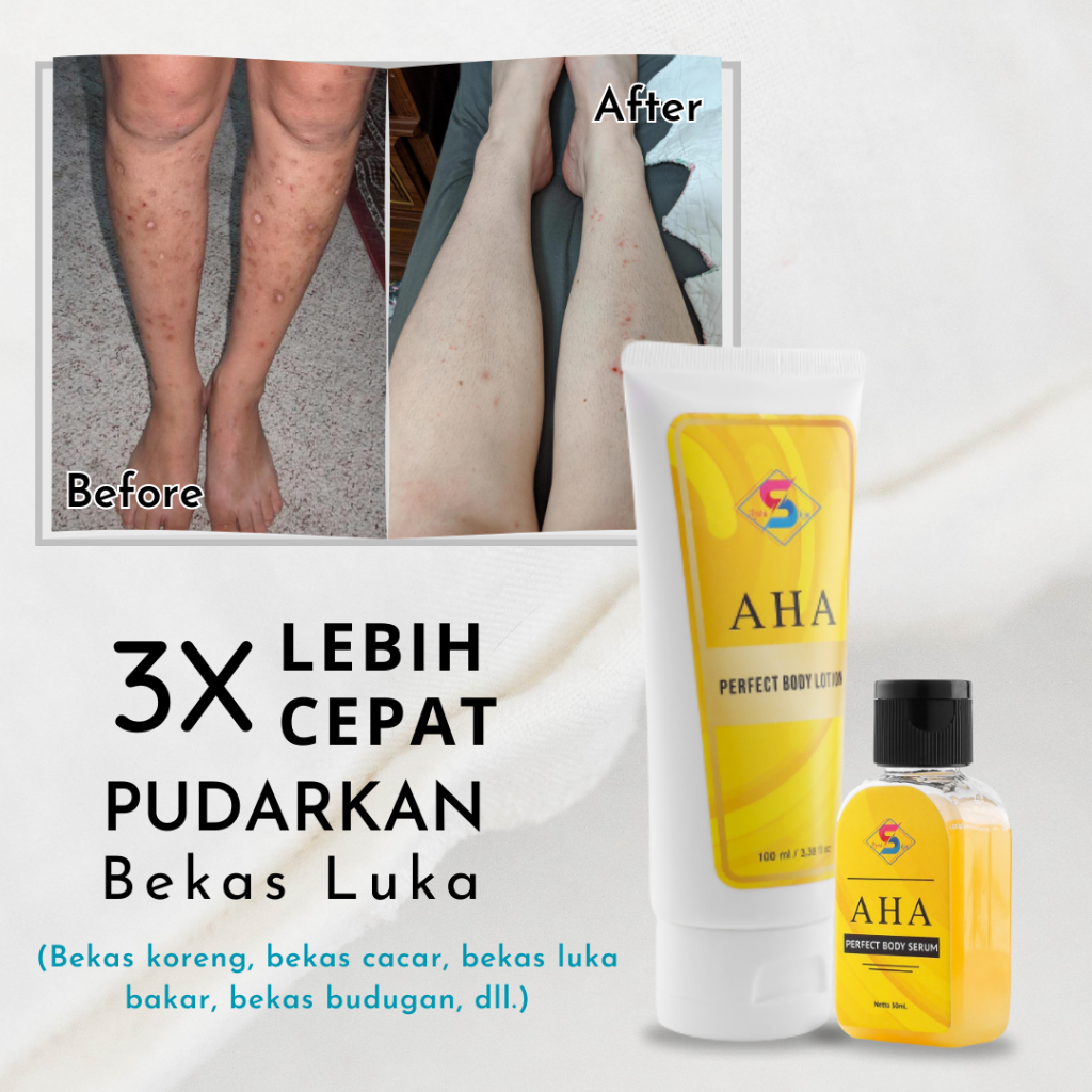 Jual Krim Penghilang Bekas Luka Koreng Cacar Budug Budukan Luka Bakar ...