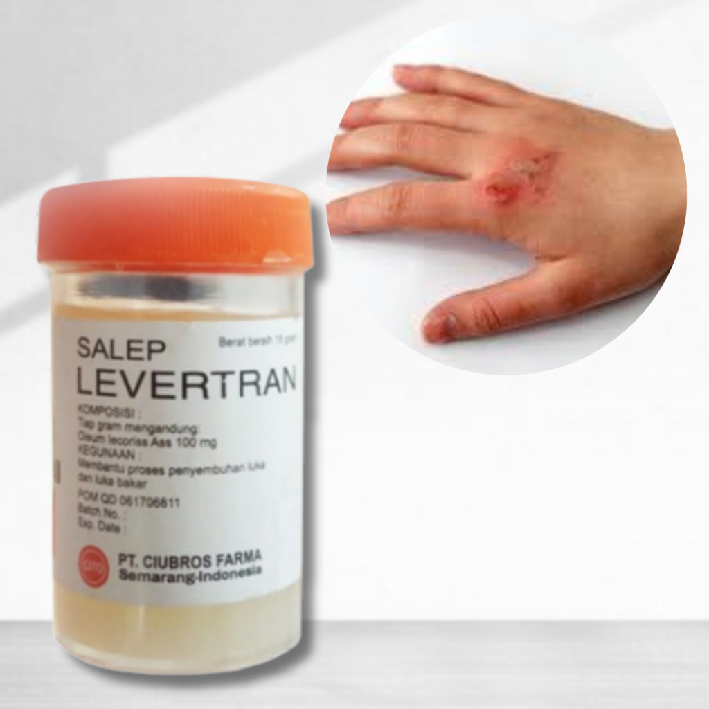 Jual salep obat luka bakar ampuh, cream untuk menyembuhkan luka bakar ...