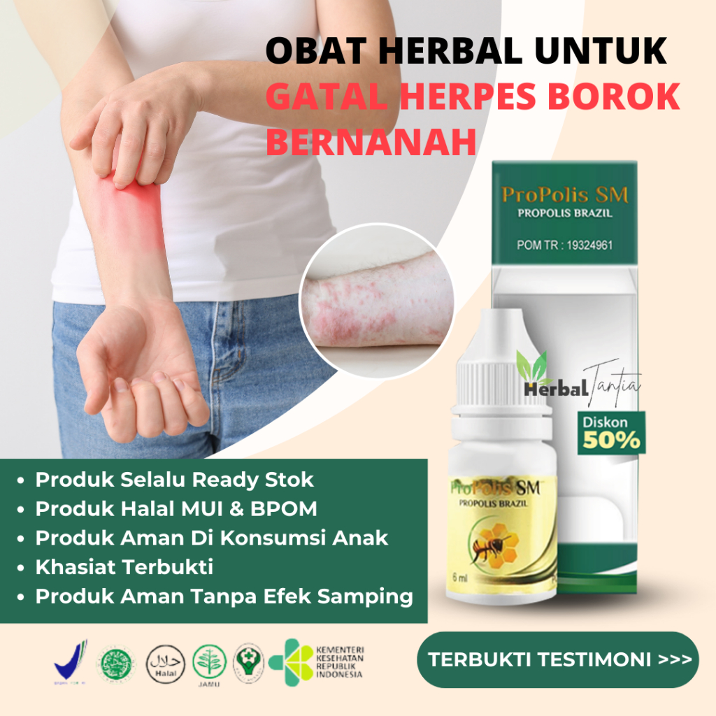 Jual Obat Herpes Zoster Cacar Air Gatal Ruam Dompo Bernanah PROPOLIS SM ...
