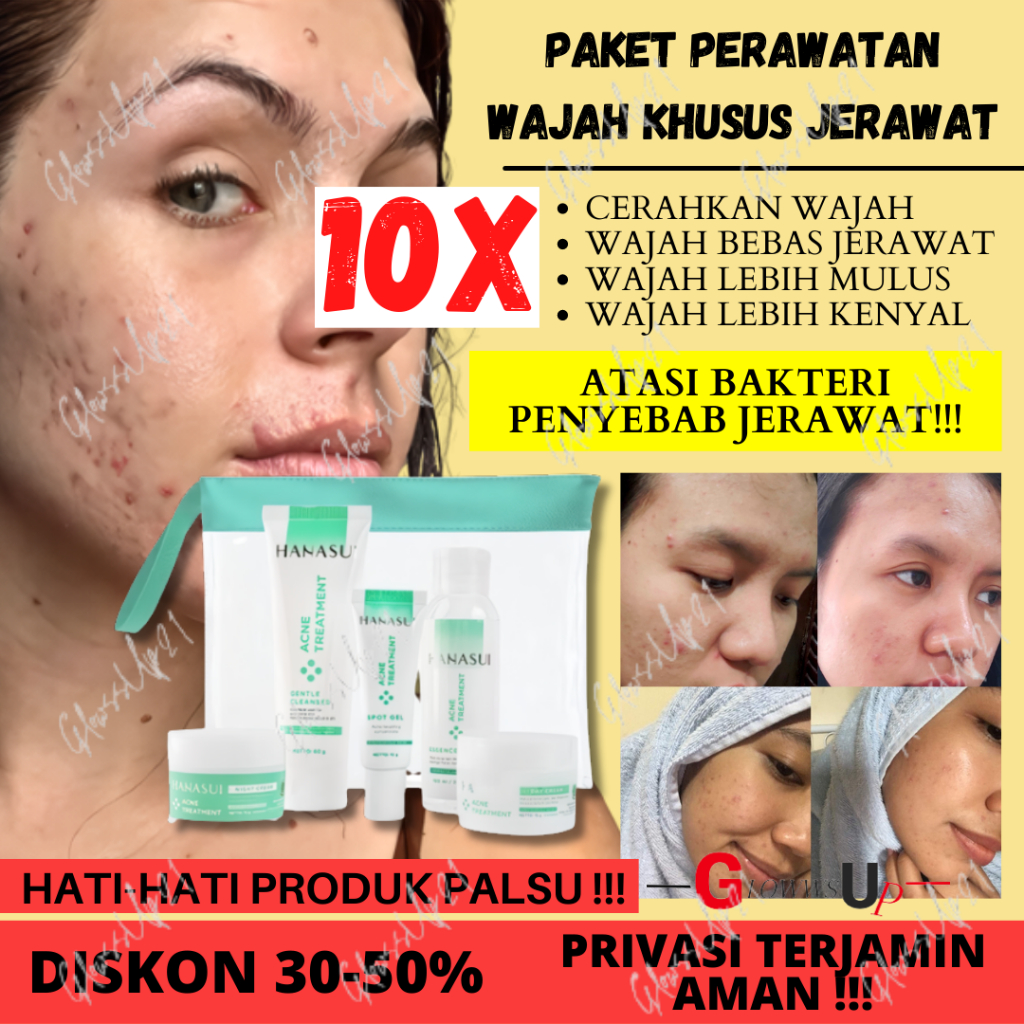Jual HANASUI ACNE TREATMENT PAKET 5IN1 ORIGINAL BPOM - CREAM ACNE ...
