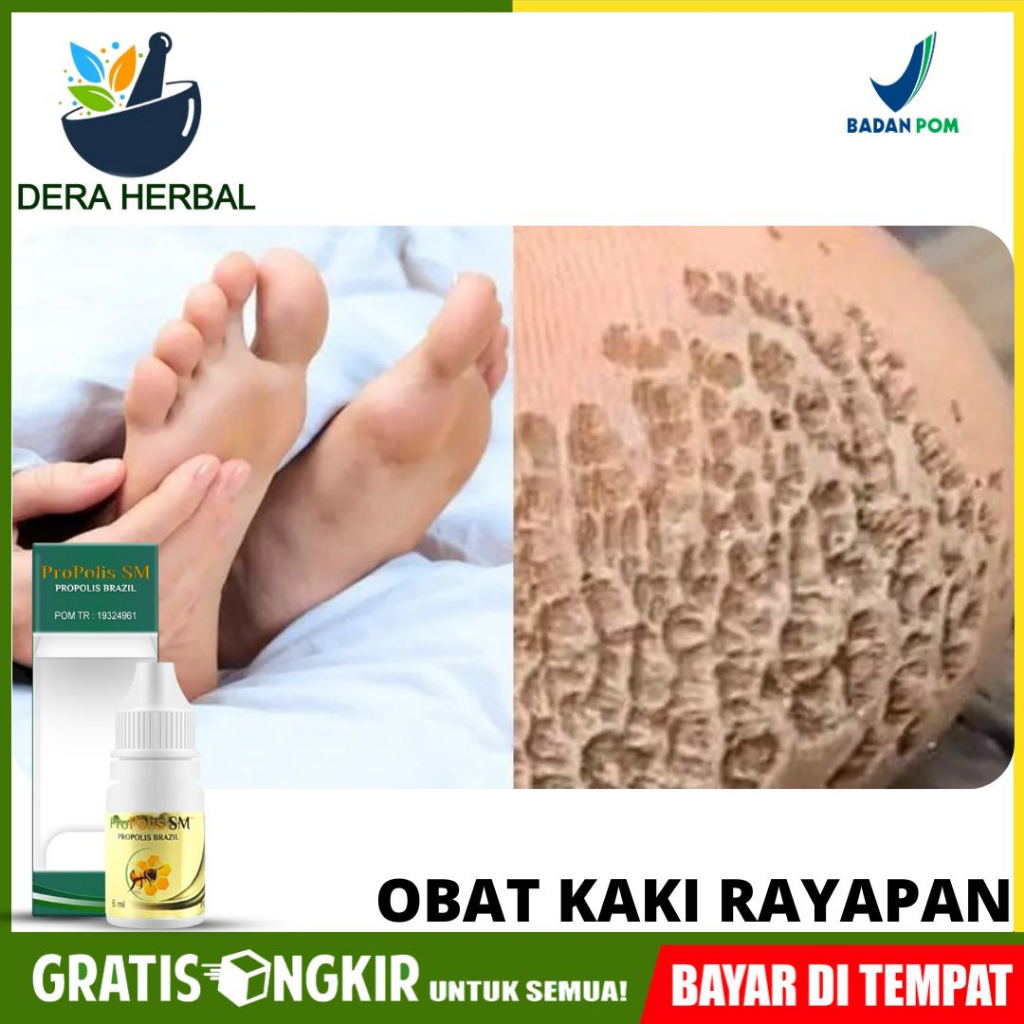 Jual Obat Kaki Rayapan Obat Kaki Bolong Obat Telapak Kaki Bolong Bolong ...