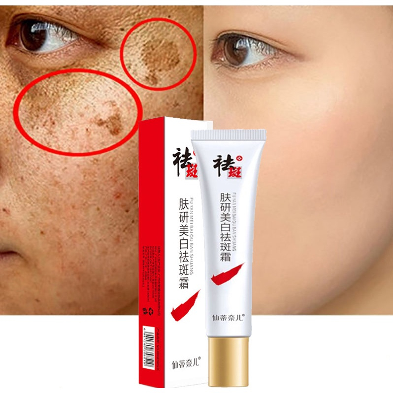 Jual CINDYNAL Whitening Freckle Cream Remove Dark Spots Penghilang Flek/Jerawat/Bintik Noda ...