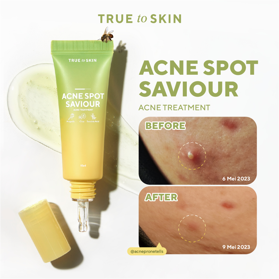 Jual True to Skin - Acne Spot Saviour (Obat Totol Jerawat) | Shopee ...