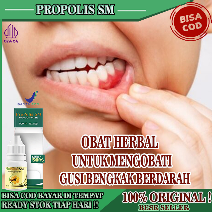 Jual Obat Gusi Bengkak Berdarah, Gusi Bernanah, Sariawan, PROPOLIS SM ...