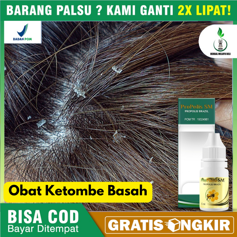 Jual Obat Ketombe , Ketombe Kering , Penghilang Ketombe Terparah Propolis Sm Herbal Asli ...