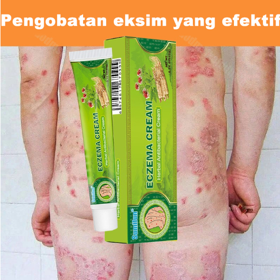 Jual Eczema Salep Anti Gatal Salep Kulit Eksim Ruam Dermatitis Anti ...