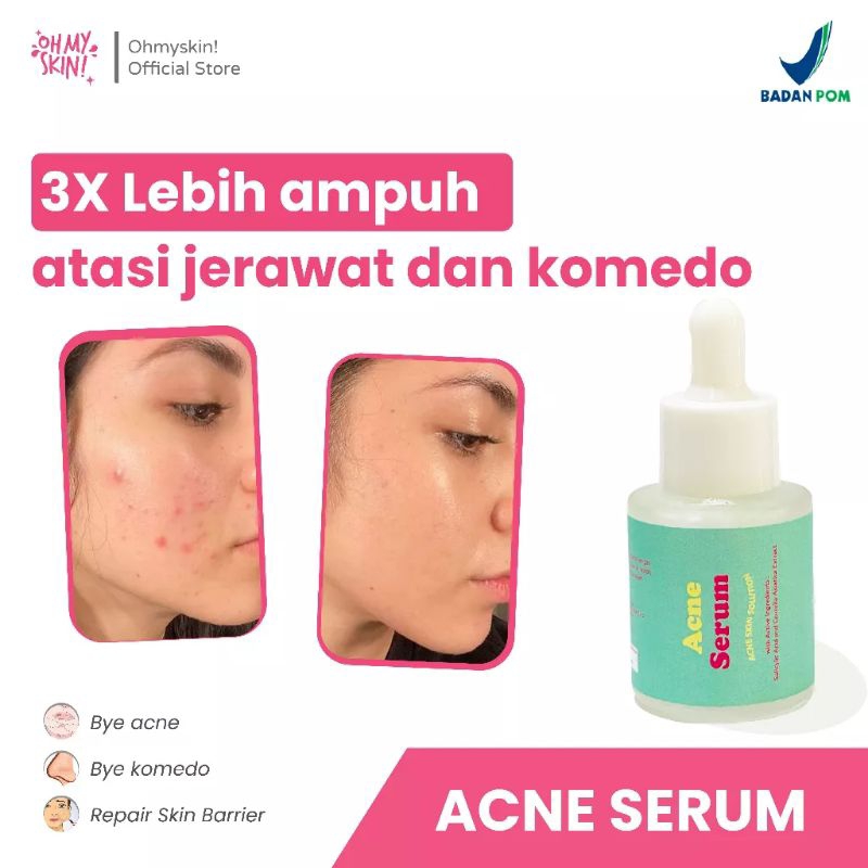 Jual Oh My Skin ! Acne serum - Bye Acne - 20 mL | Shopee Indonesia