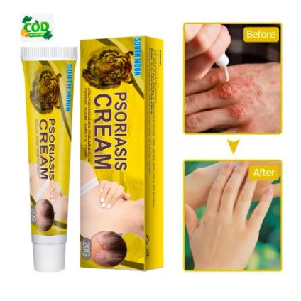 Jual Psoriasis Cream Eczema Salep Anti Gatal Salep Kulit Eksim Ruam ...
