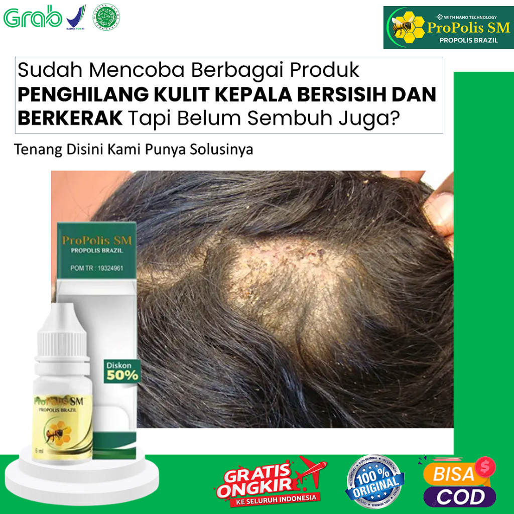 Jual Propolis sm Obat Borok Di Kepala, Korengan, Kulit Kepala Bersisik Berkerak Infeksi Jamur ...