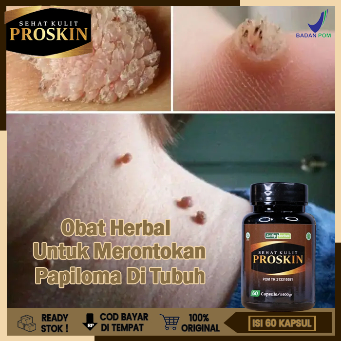 Jual Obat Perontok Papiloma, Obat Kutil Leher Papiloma, Obat Penghilang ...