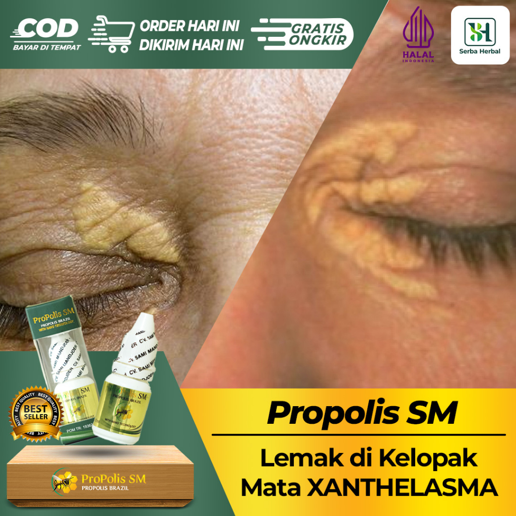 Jual Obat xanthelasma - obat lemak kelopak mata, lemak yang tumbuh di ...