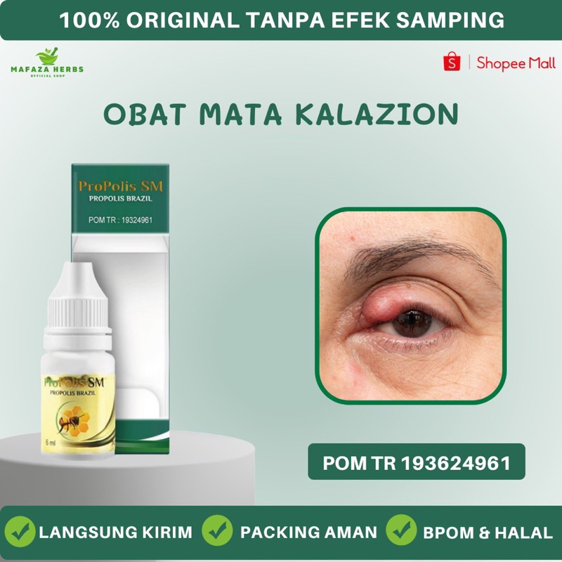 Jual Obat Mata Kalazion, Obat Mata Bintitan, Obat Kalazion Di Kelopak ...