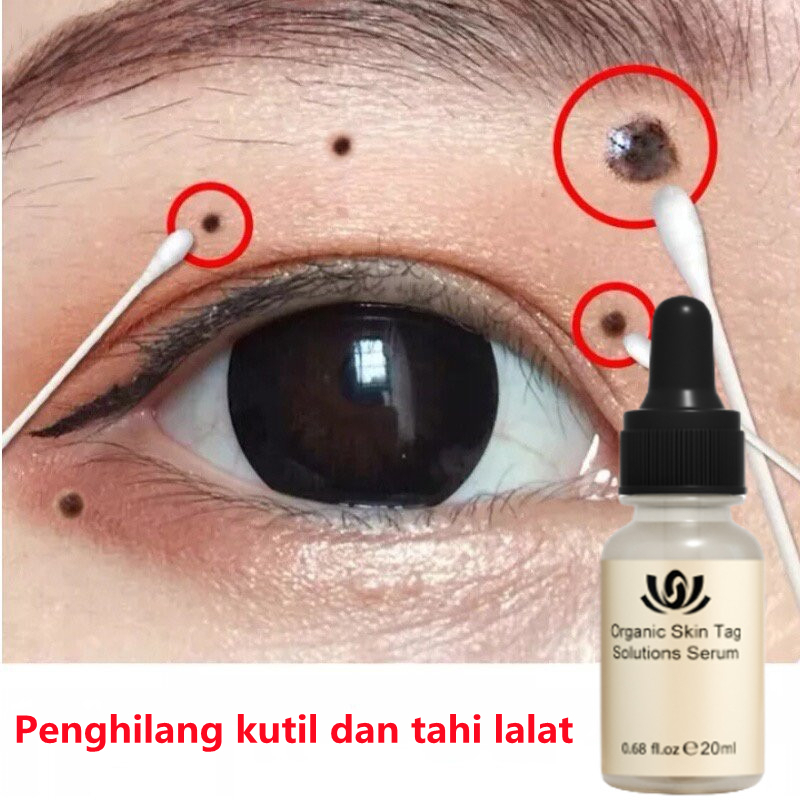 Jual Penghilang Tahi Lalat Penghilang Kutil Skin Tag Remover Penghilang ...
