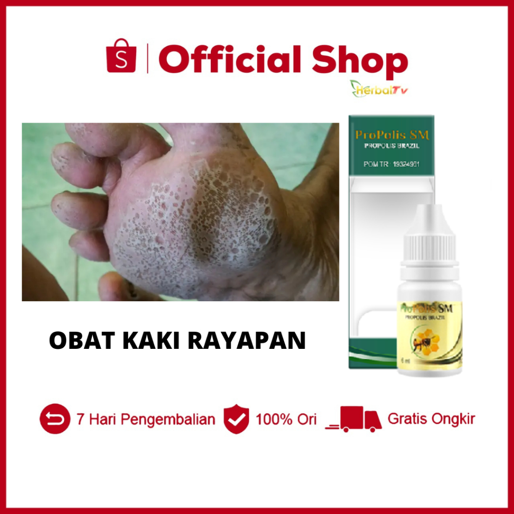 Jual Obat Kutu Air Gatal Pada Jari kaki sela sela kaki Berjamur ...