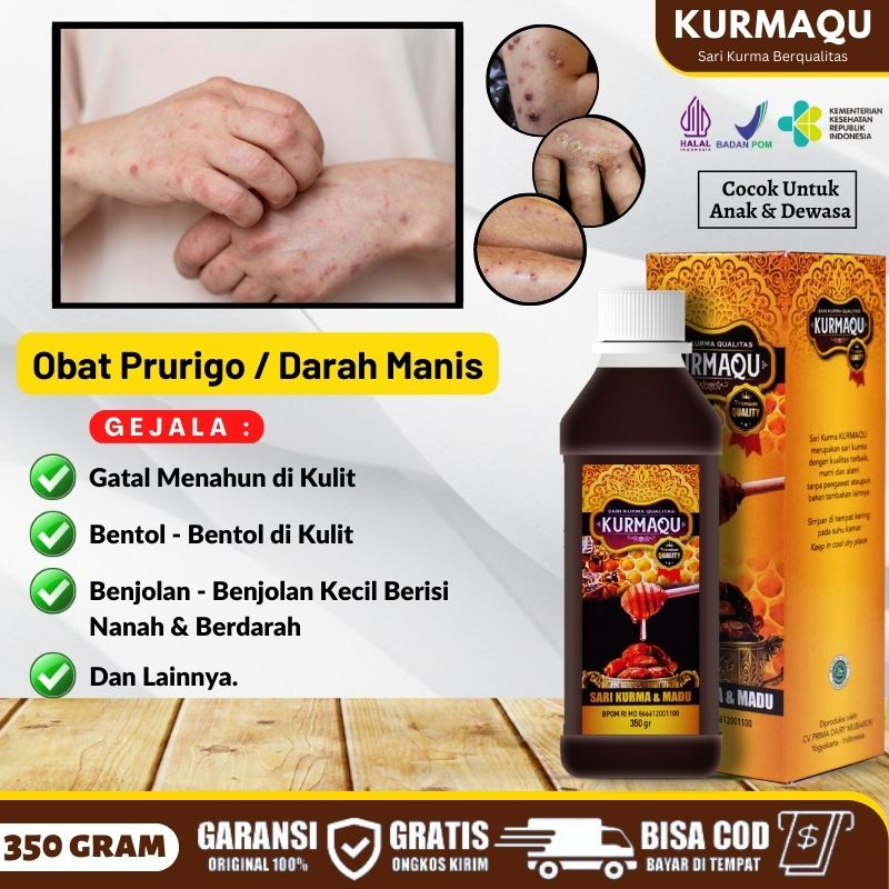 Jual Obat Gatal Prurigo, Obat Bentol - Bentol Bernanah di Kulit ...