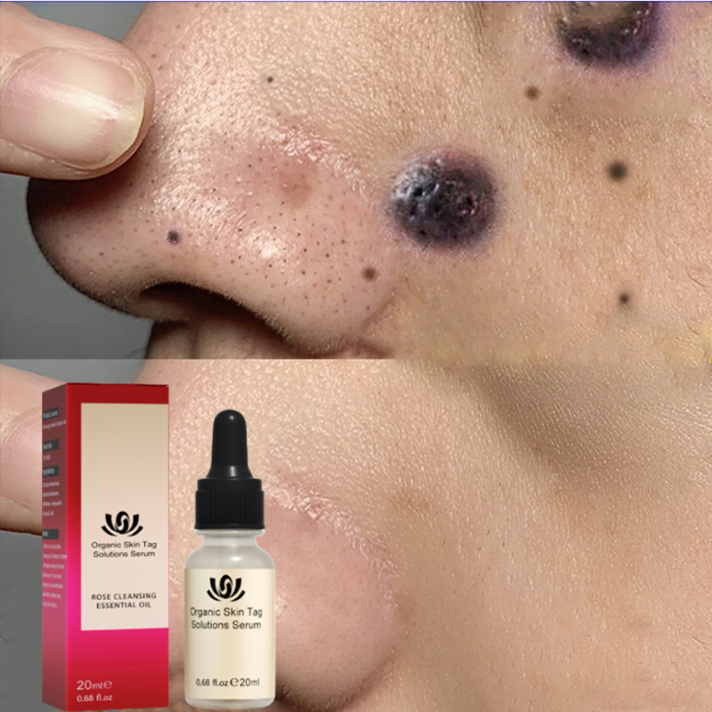 Jual Penghilang Tahi Lalat Penghilang Kutil Skin Tag Remover Penghilang ...