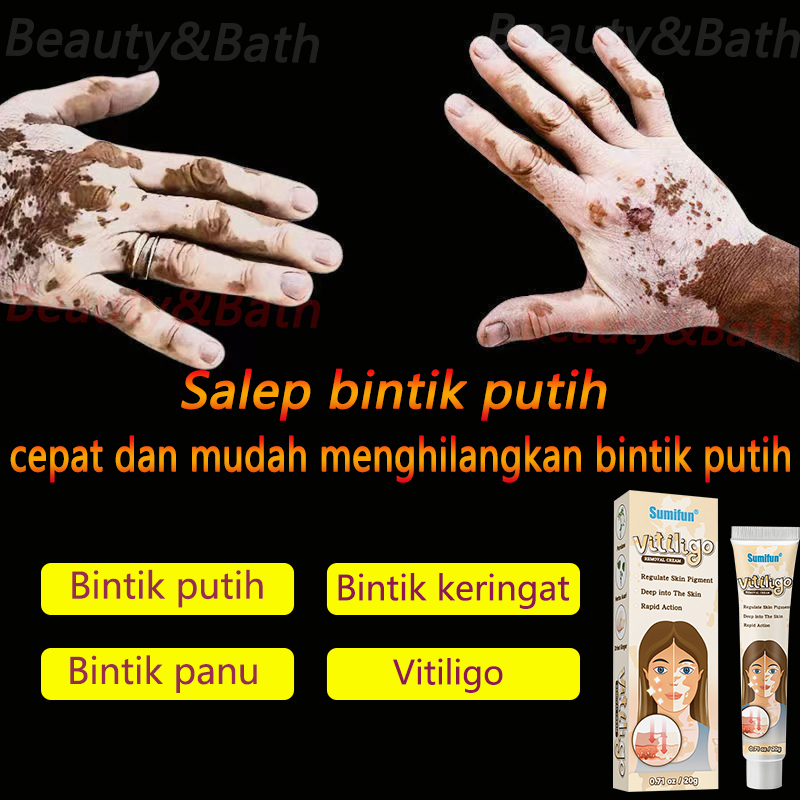 Jual （Barang asli）salep vitiligo - obat panu - salep panu 20g cepat dan ...
