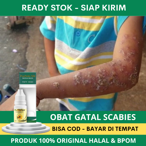 Jual Obat Gatal Scabies Manusia, Obat Kudis & Scabies, Obat Gatal ...