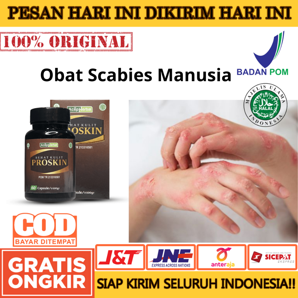 Jual Obat Scabies Manusia Borok Menahun Gudik Cacar Api Cacar Air ...