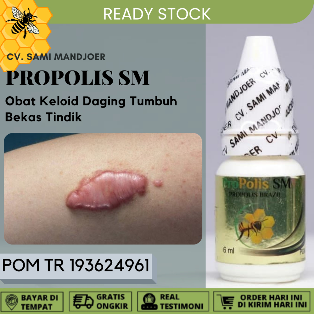 Jual Obat Keloid, Penghilang keloid, Daging Tumbuh, Daging Jadi, Skin ...