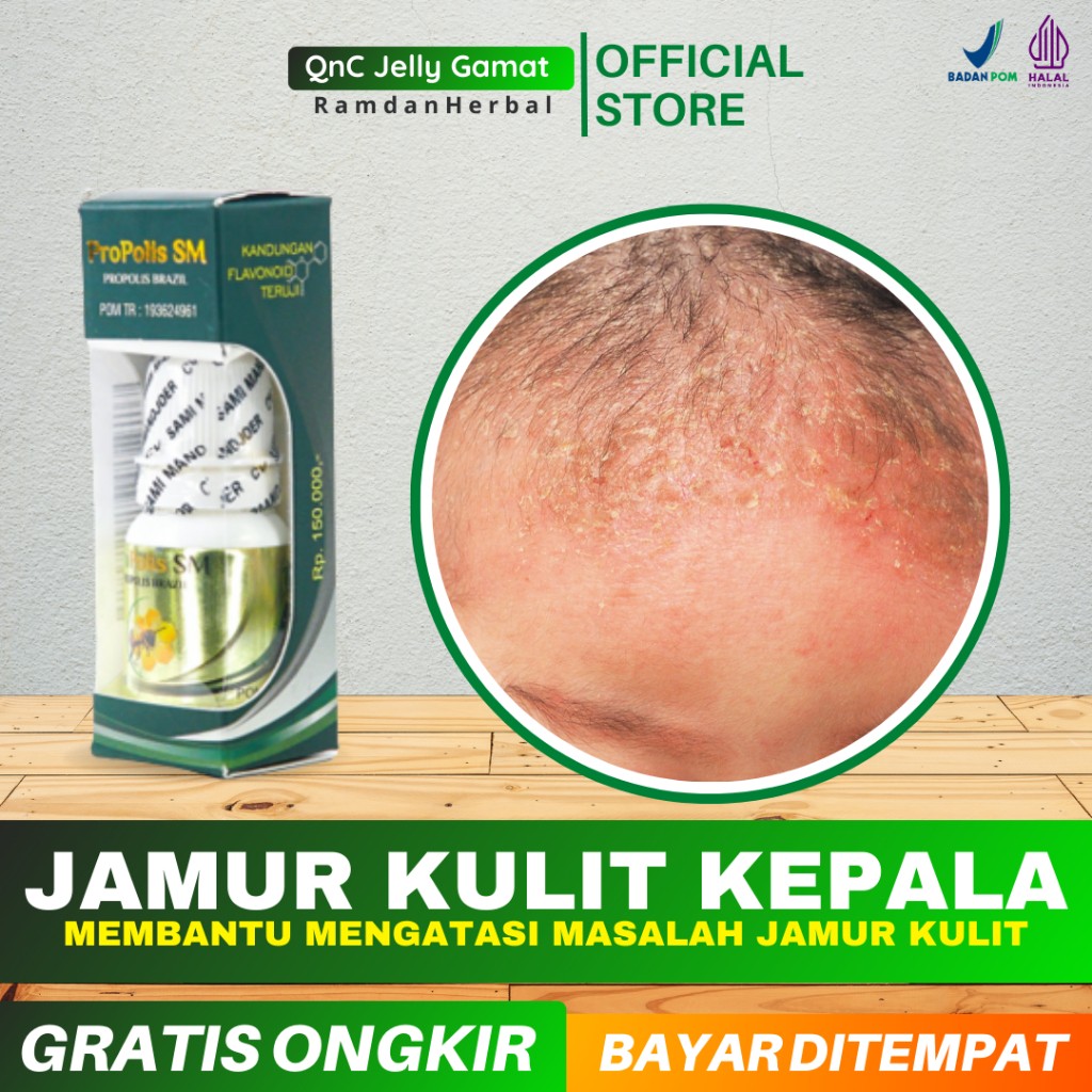 Jual COD Obat Jamur Di Kulit Kepala Anak Tinea Capitis Kulit Kepala Bersisik Gatal Kurap Kepala ...