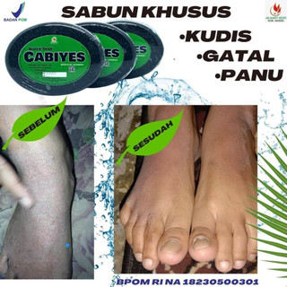 Jual CABIYES Sabun untuk Mengatasi Gatal Scabies Kudis Eksim Kurap Panu ...