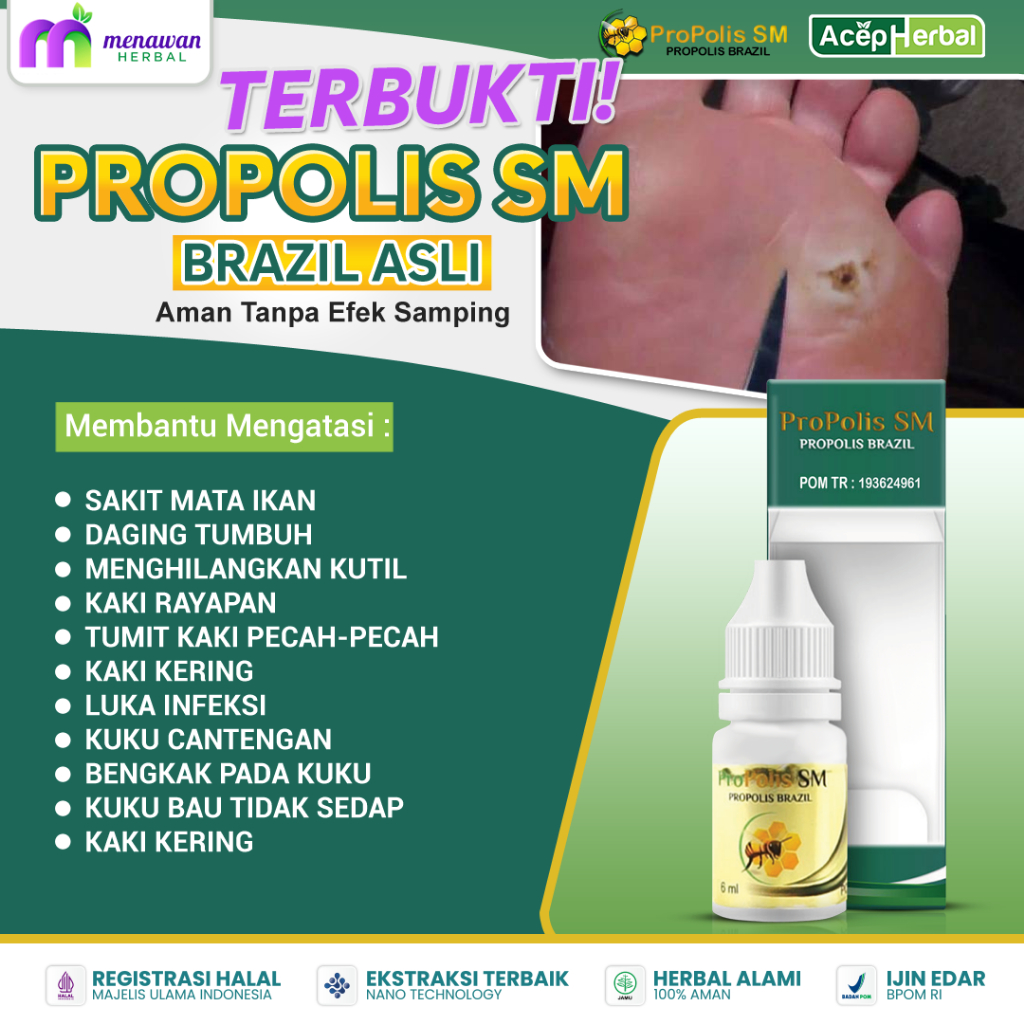 Jual Propolis SM - Obat Mata ikan, Obat kutil kaki, Obat mata ikan di ...
