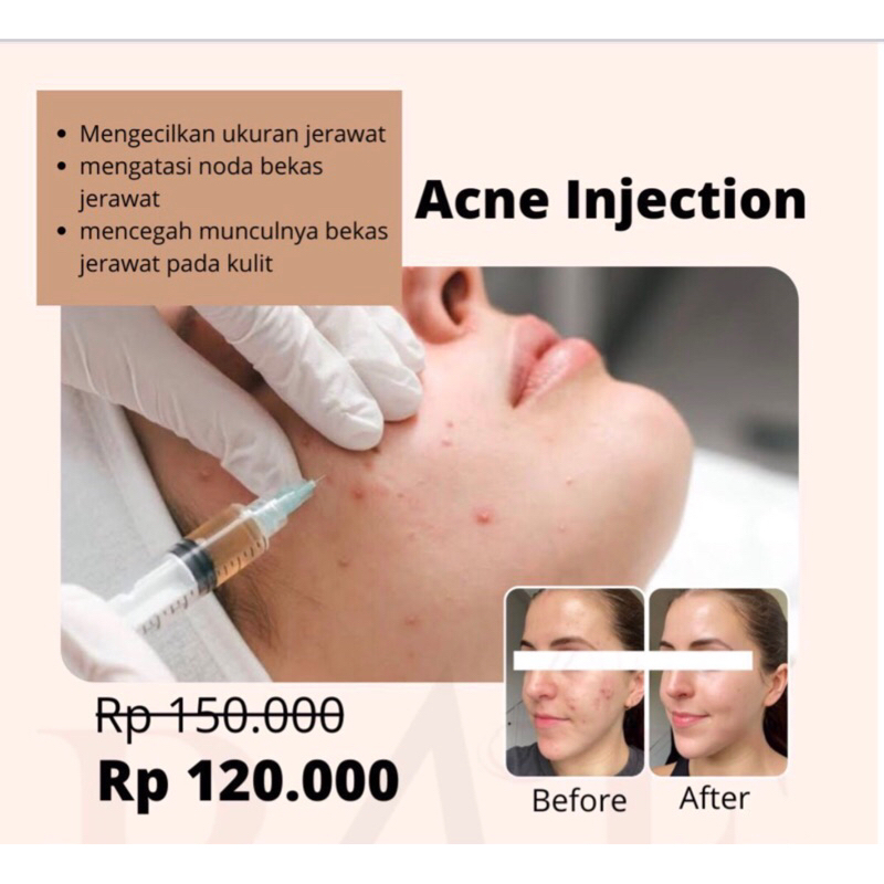 Jual Acne injection | Shopee Indonesia