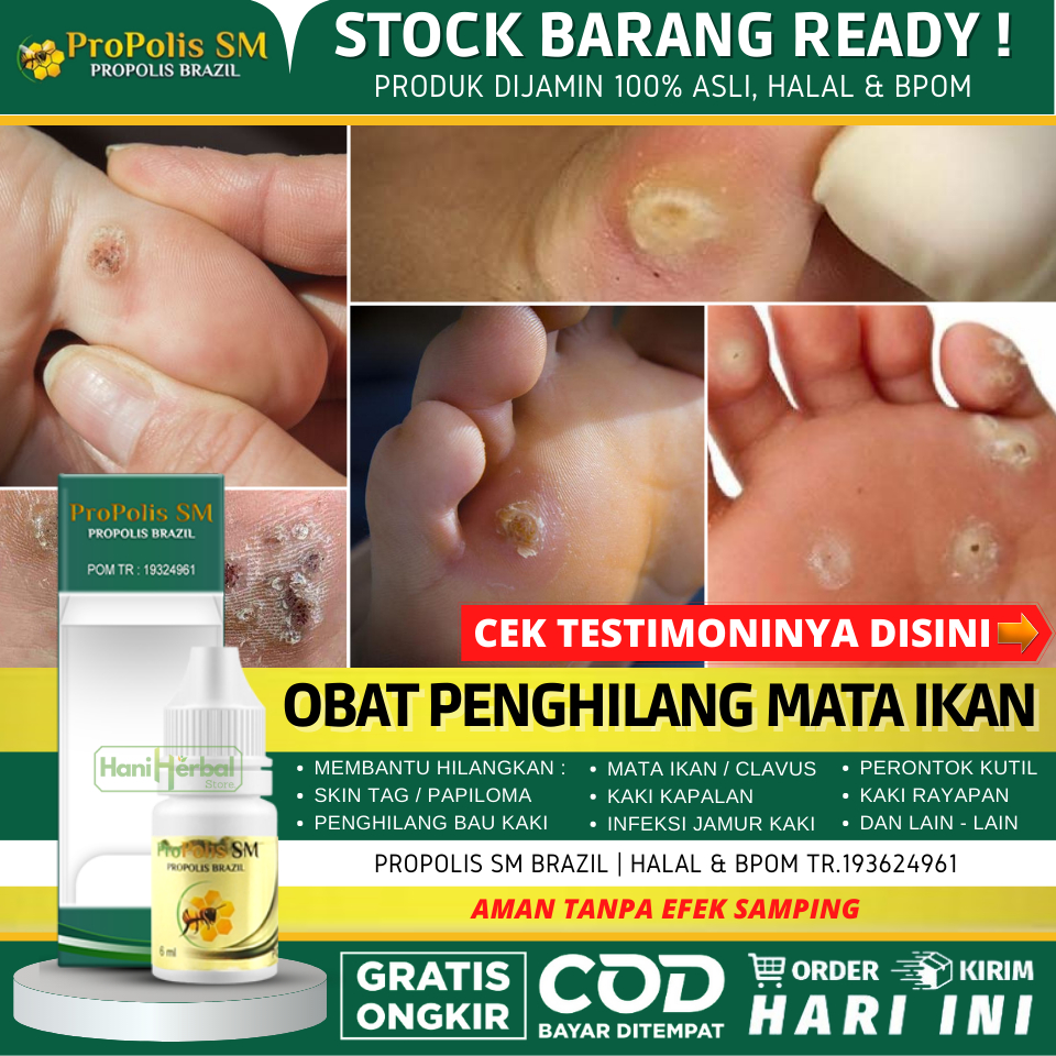 Jual Obat Oles Penghilang Mata Ikan di Kaki, Mata Ikan di Jari Tangan ...