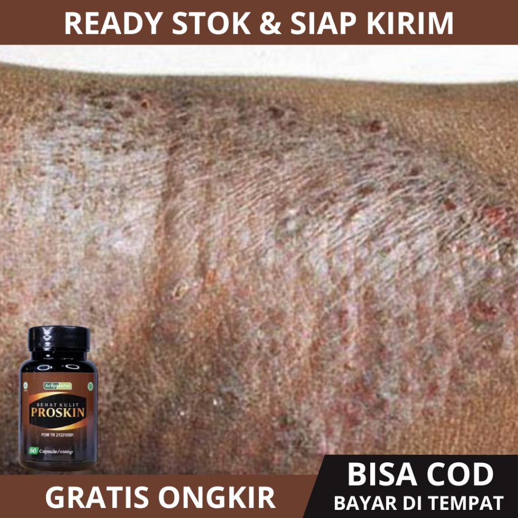 Jual Obat Eksim Kulit Gatal Untuk Gatal Gatal, Obat Gatal Exim Kering ...