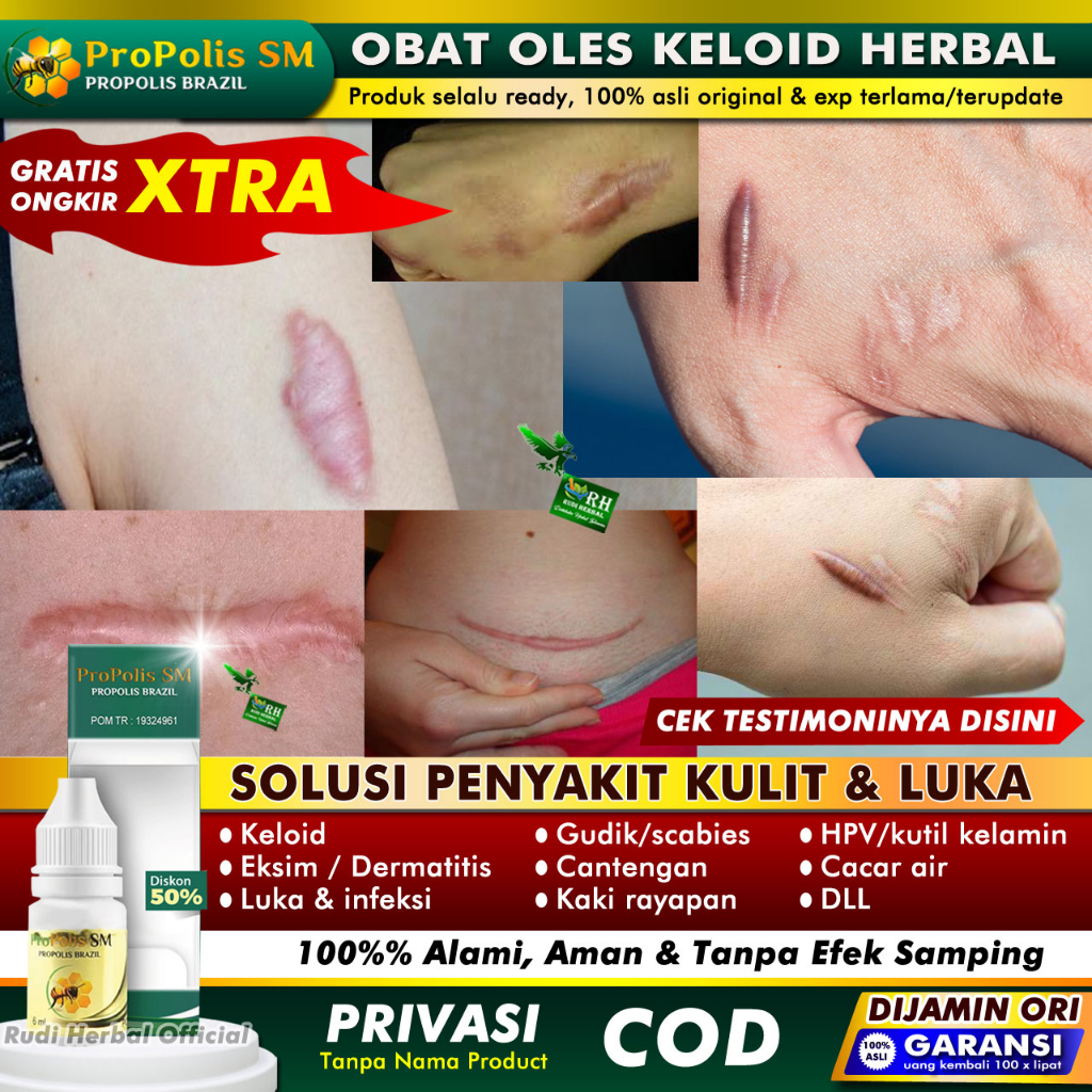 Jual Obat Oles Keloid Daging Tumbuh Di Bekas Operasi Dan Luka, Penumpas & Penghilang Kloid ...