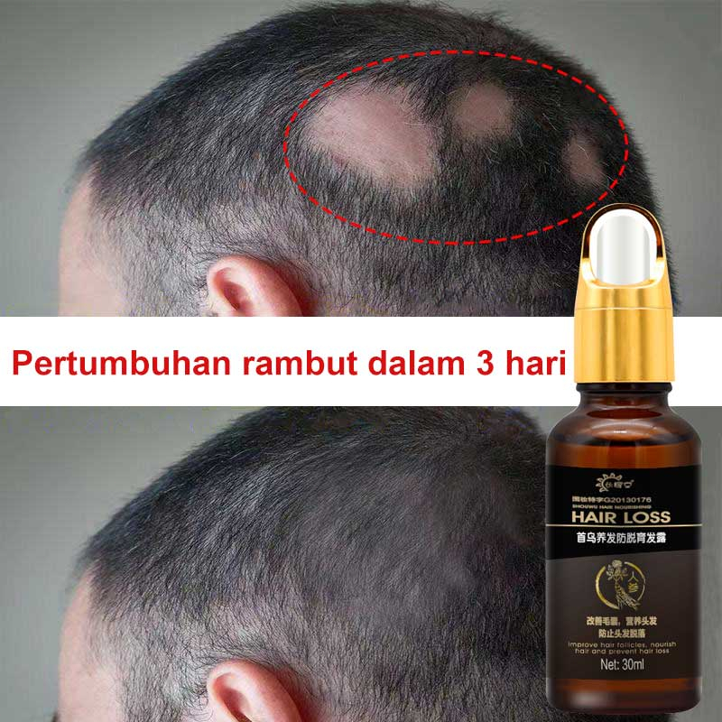 Jual Penumbuh rambut botak Serum penumbuh rambut 30ml Penumbuh rambut ...