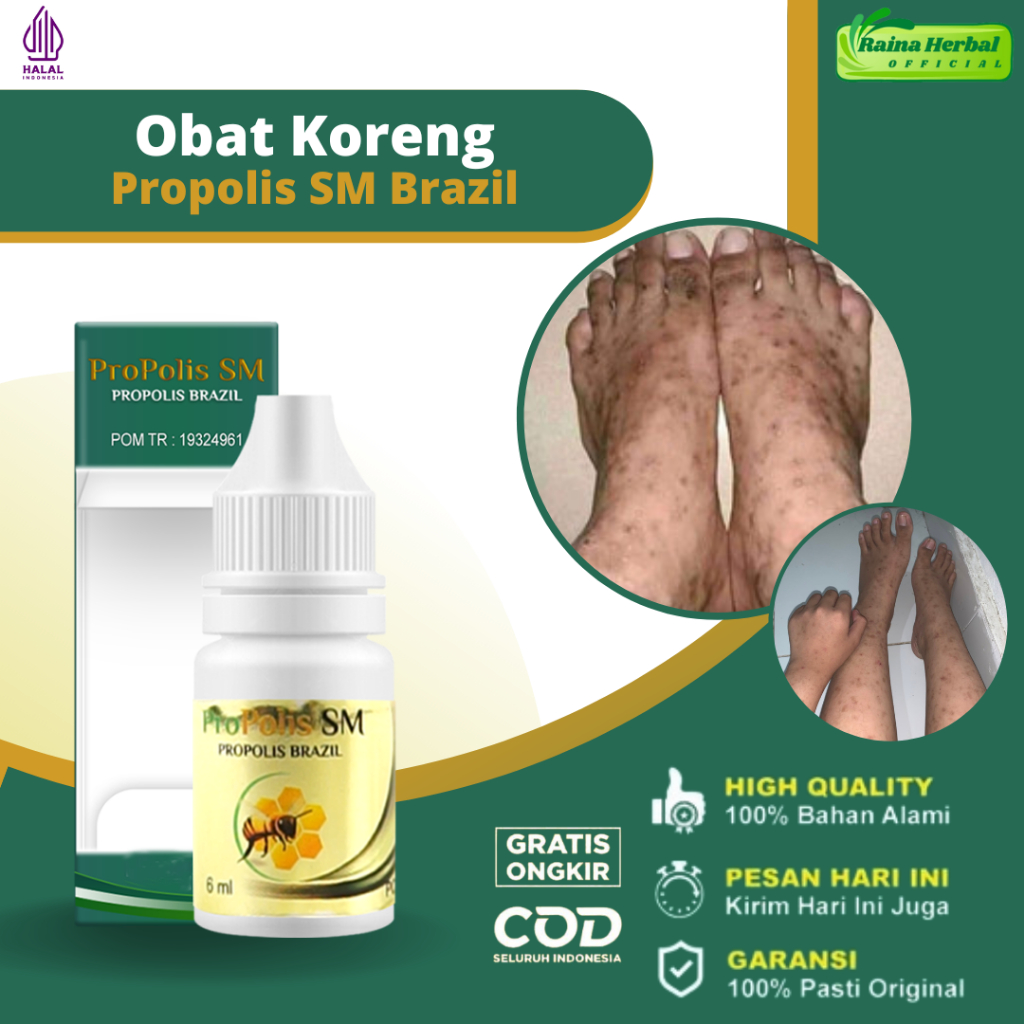 Jual Raina Herbal - Obat Oles Koreng di Kaki Dan Tangan, Obat Koreng ...