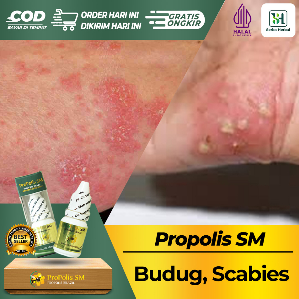 Jual Obat Budug Atau Skabies Budug Di Kaki Budug Bernanah Budug Cenang ...