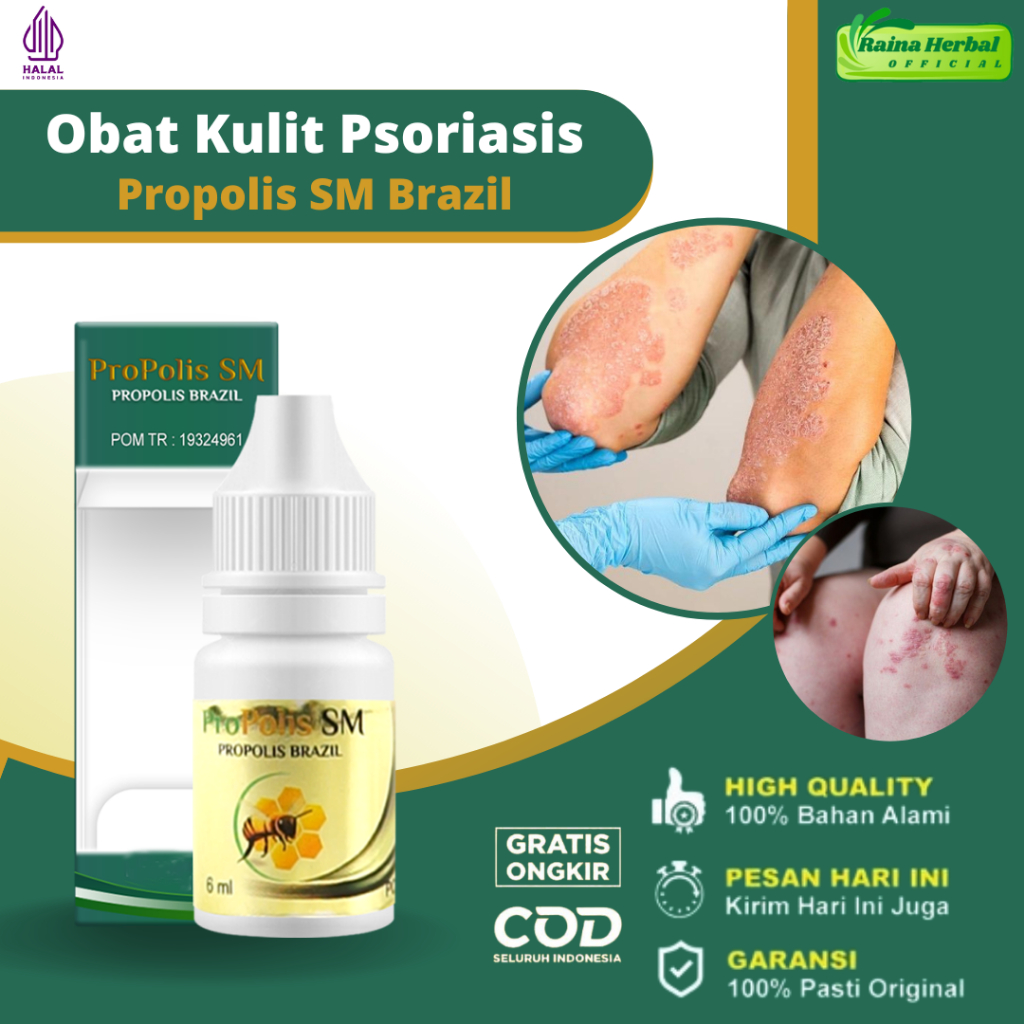 Jual Raina Herbal - Obat Kulit Mengelupas, Psoriasis, Gatal Eksim Basah ...
