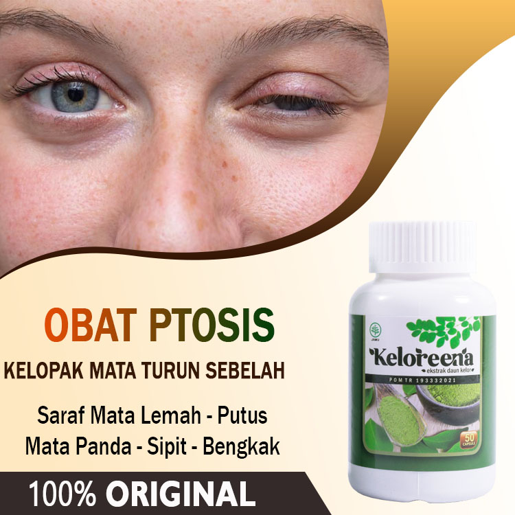 Jual Obat Kelopak Mata Turun Sebelah, Mata Panda, Sipit, Saraf Mata Putus, Rusak, Lemah, Ptosis ...