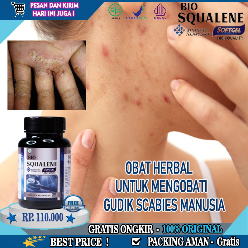 Jual Obat Gudik Scabies Manusia, Gatal Bernanah, Infeksi Kulit Scabies ...