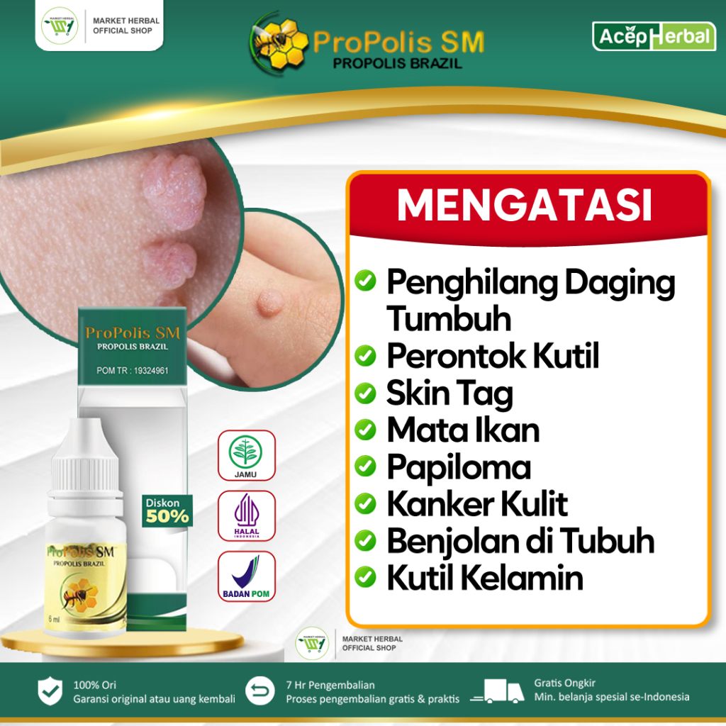 Jual Obat Daging Tumbuh Obat Kutil Penghilang Kutil Mata Ikan Kutil ...