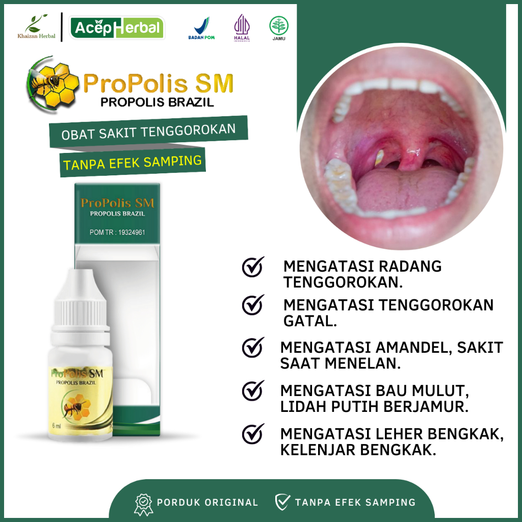 Jual Obat Sakit Tenggorokan Anak dan Dewasa dengan PROPOLIS SM Solusi Obat Radang tenggorokan ...
