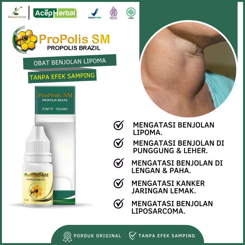 Jual Obat Lipoma - Benjolan di Punggung, Benjolan di Paha, Benjolan di ...