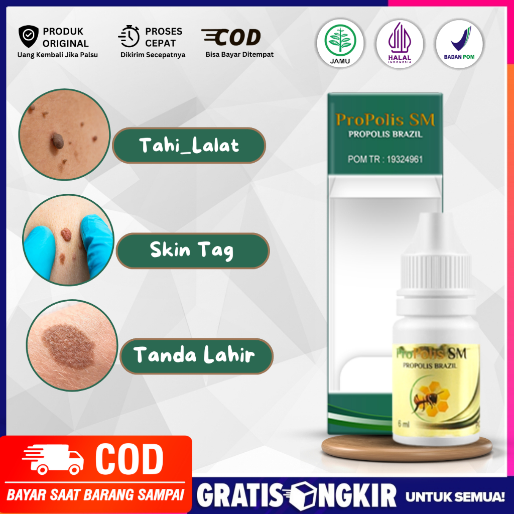 Jual Obat Tetes Perontok Tahi Lalat, Obat Oles Penghilang Nevi, Salep ...