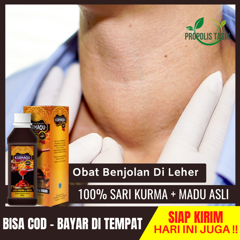 Jual Obat Benjolan Di Leher Radang Tenggorokan Kelenjar Tiroid Bengkak ...