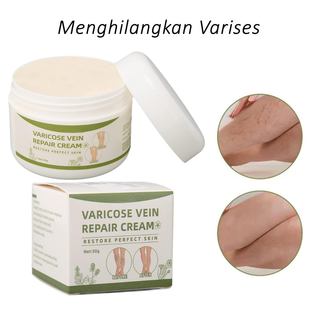 Jual EELHOE Varicose Veins Obat Varises Krim Salep China Untuk ...