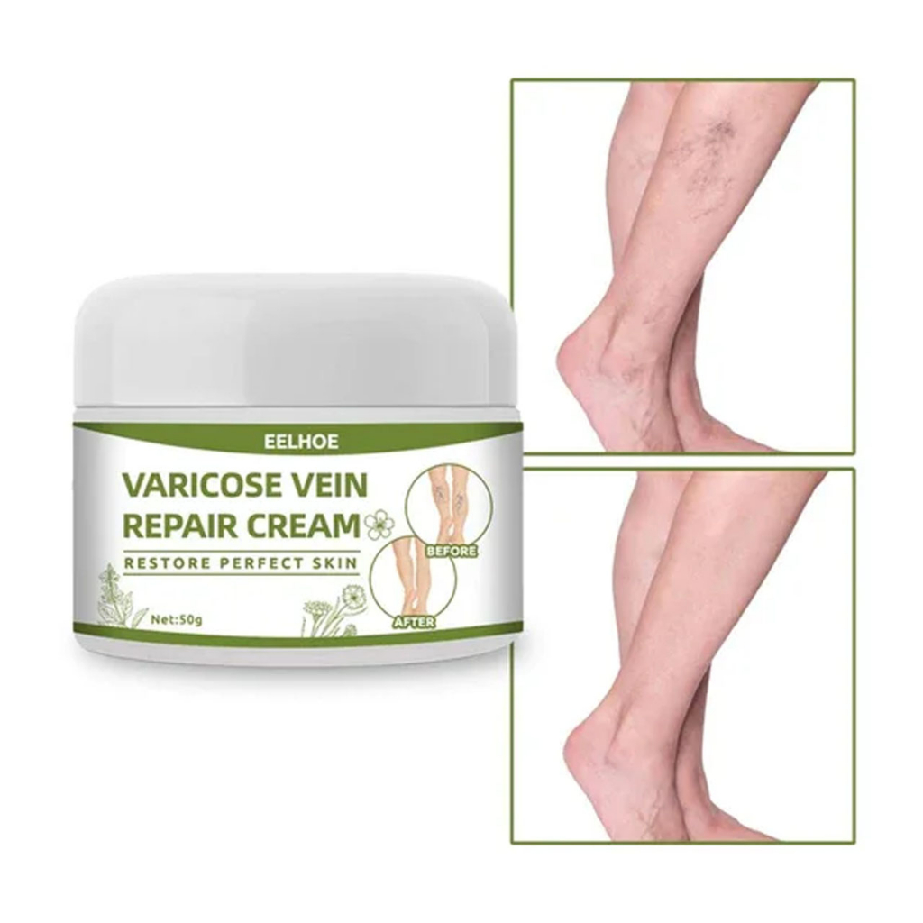 Jual EELHOE Varicose Veins Krim Medis Pengobatan Varises Salep Varises ...