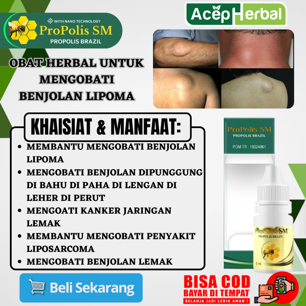Jual Obat Lipoma - Benjolan di Punggung, Benjolan di Paha, Benjolan di ...