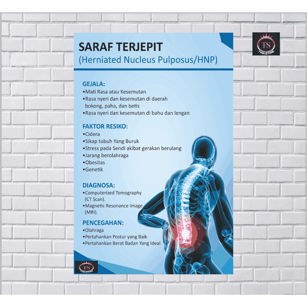 Jual [ NEW ] Poster Kesehatan Tentang Saraf Kejepit/Terjepit | Shopee ...