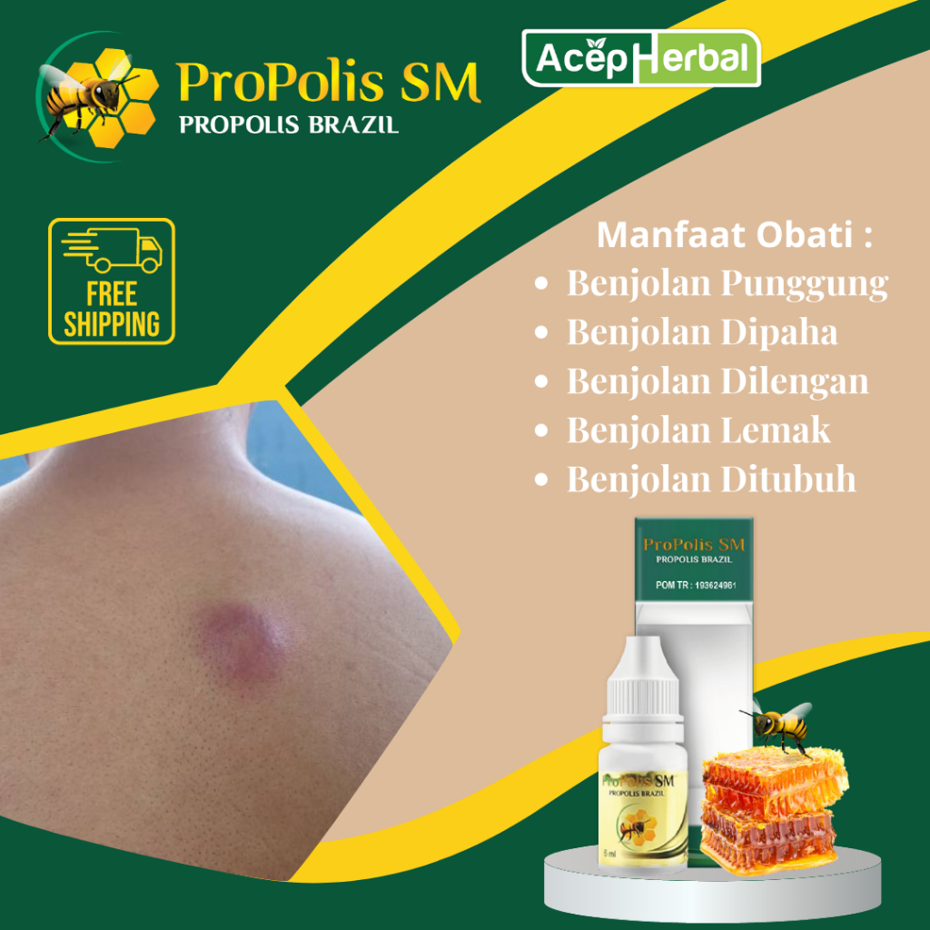 Jual Obat Lipoma - Benjolan di Punggung, Benjolan di Paha, Benjolan di ...