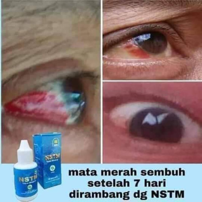 Jual NSTM 100% ORIGINAL BISA OBATI KATARAK , MATA MINUS DAN PENYAKIT ...