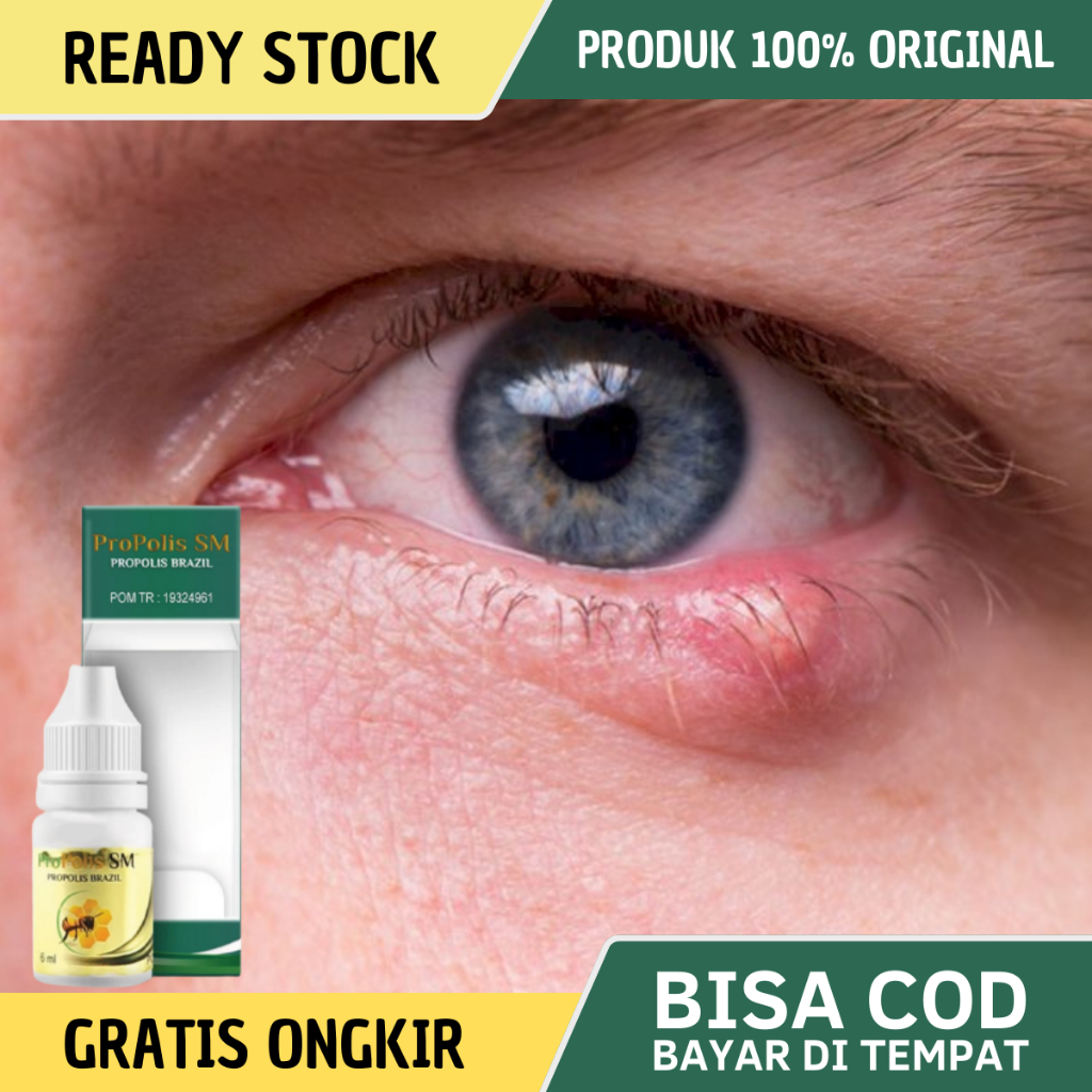 Jual Obat Bintitan Mata - Obat Buat Mata Bintitan - Kelopak Mata ...