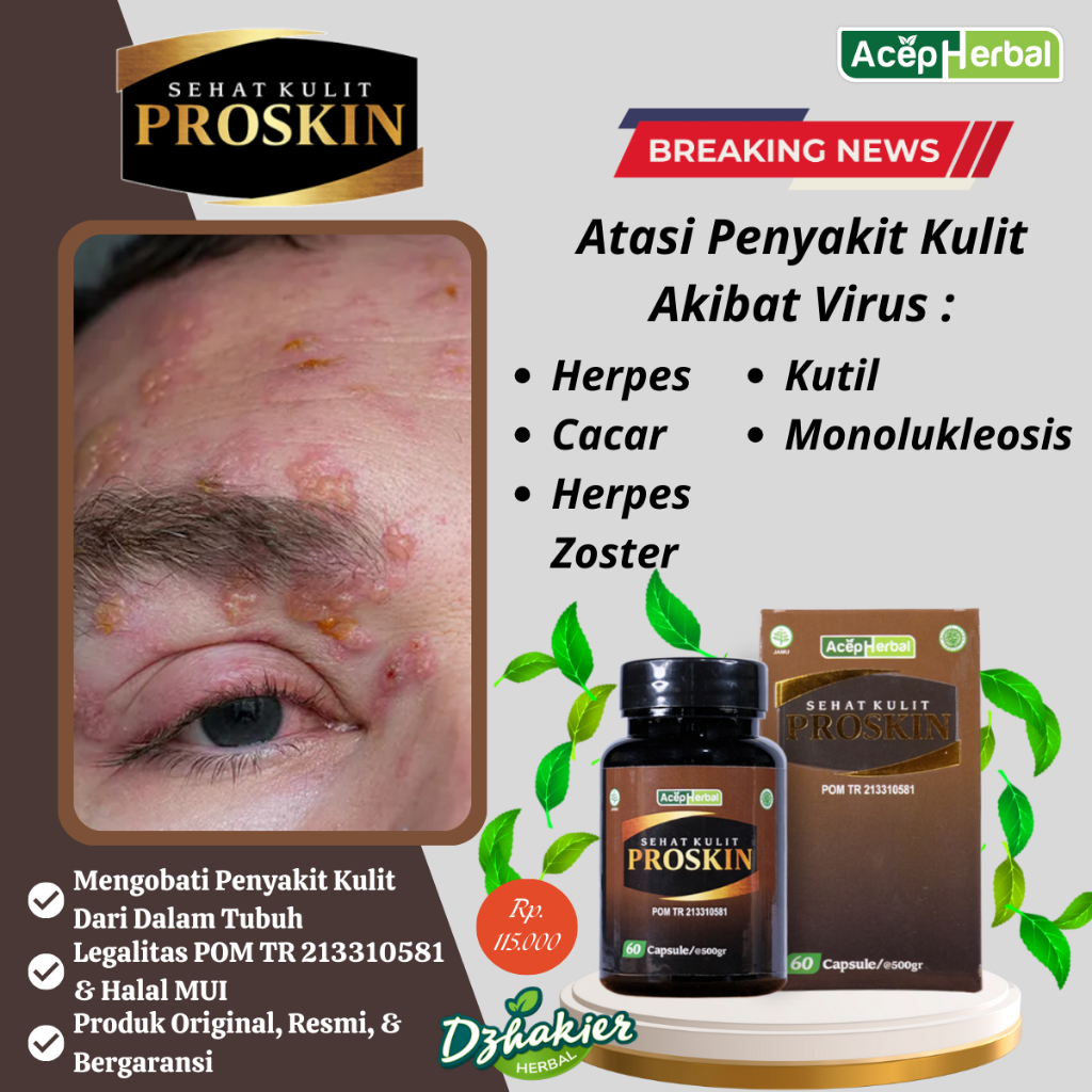 Jual Obat Penyakit Kulit Akibat Virus, Herpes, Cacar, Cacar Air, Herpes ...